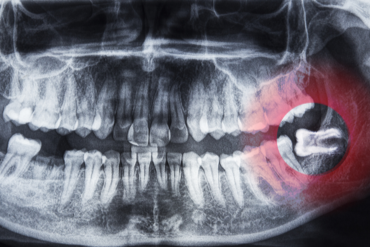 Wisdom Teeth Symptoms - Third Molars - Wisdom Teeth Guide